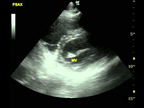 Normal parasternal short axis (PSAX) echo at mitral valve.wmv - YouTube