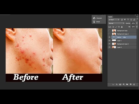3 Easy Way to Remove from face acne in Photoshop - YouTube