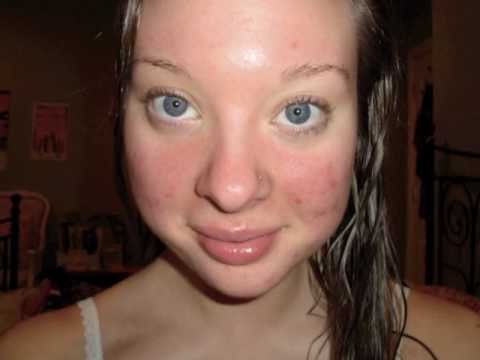 ACCUTANE PHOTO PROGRESS: Day 10 - YouTube