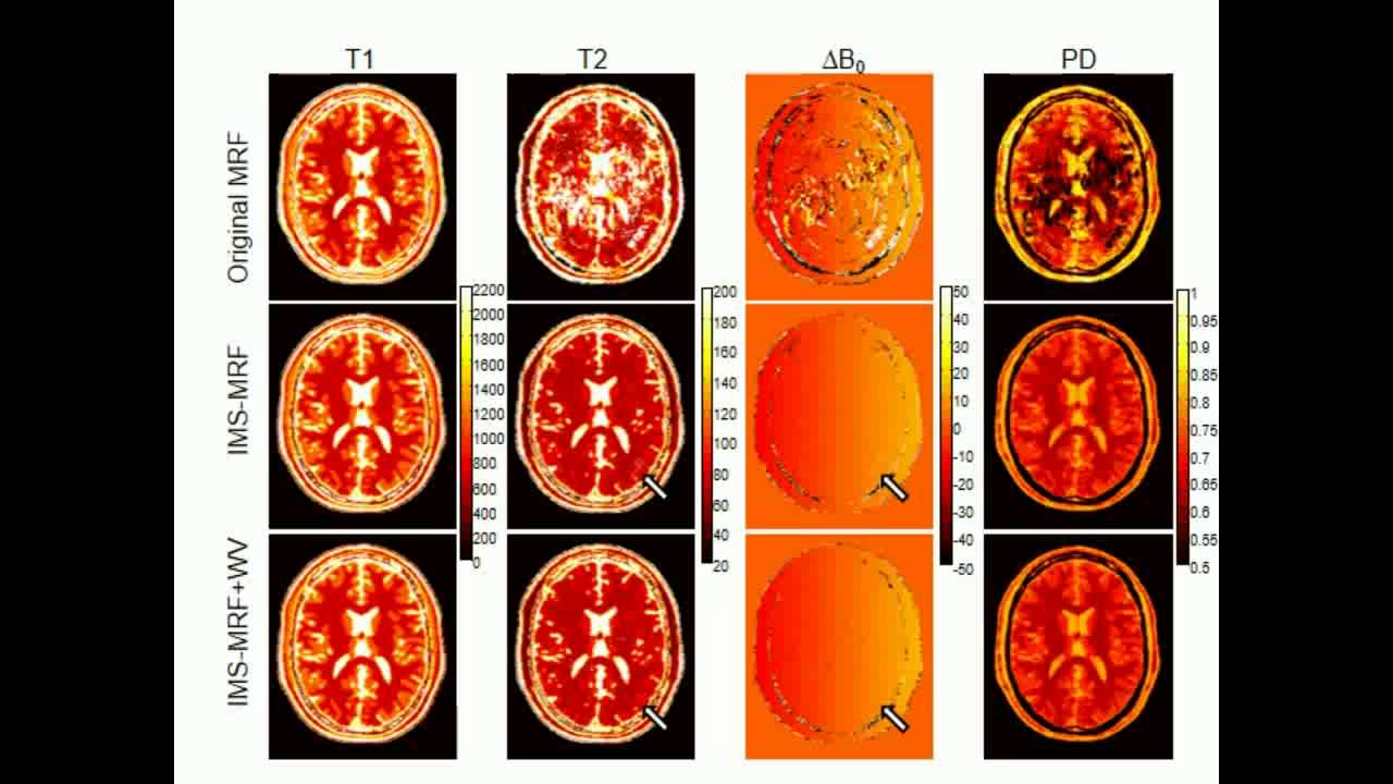 Eric Pierre: Multiscale reconstruction for MR fingerprinting - YouTube