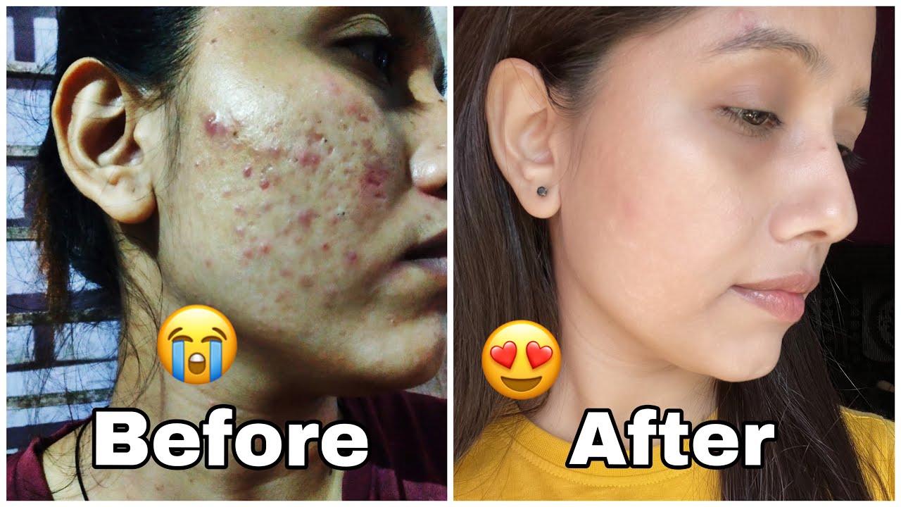 How I Cleared My Skin In 30 Days / My skin transformation Cystic acne ...