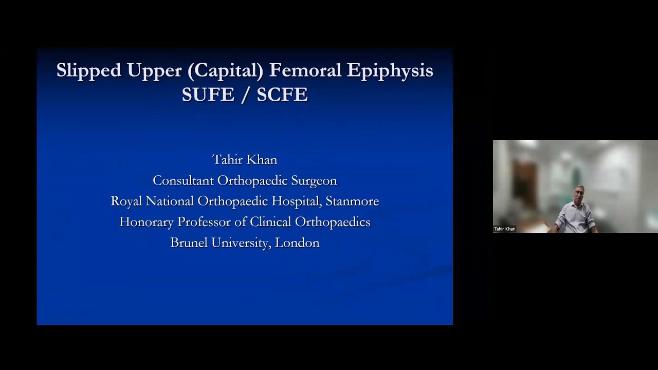 Slipped upper (capital) femoral epiphysis (SUFE) by Mr Tahir Khan - YouTube