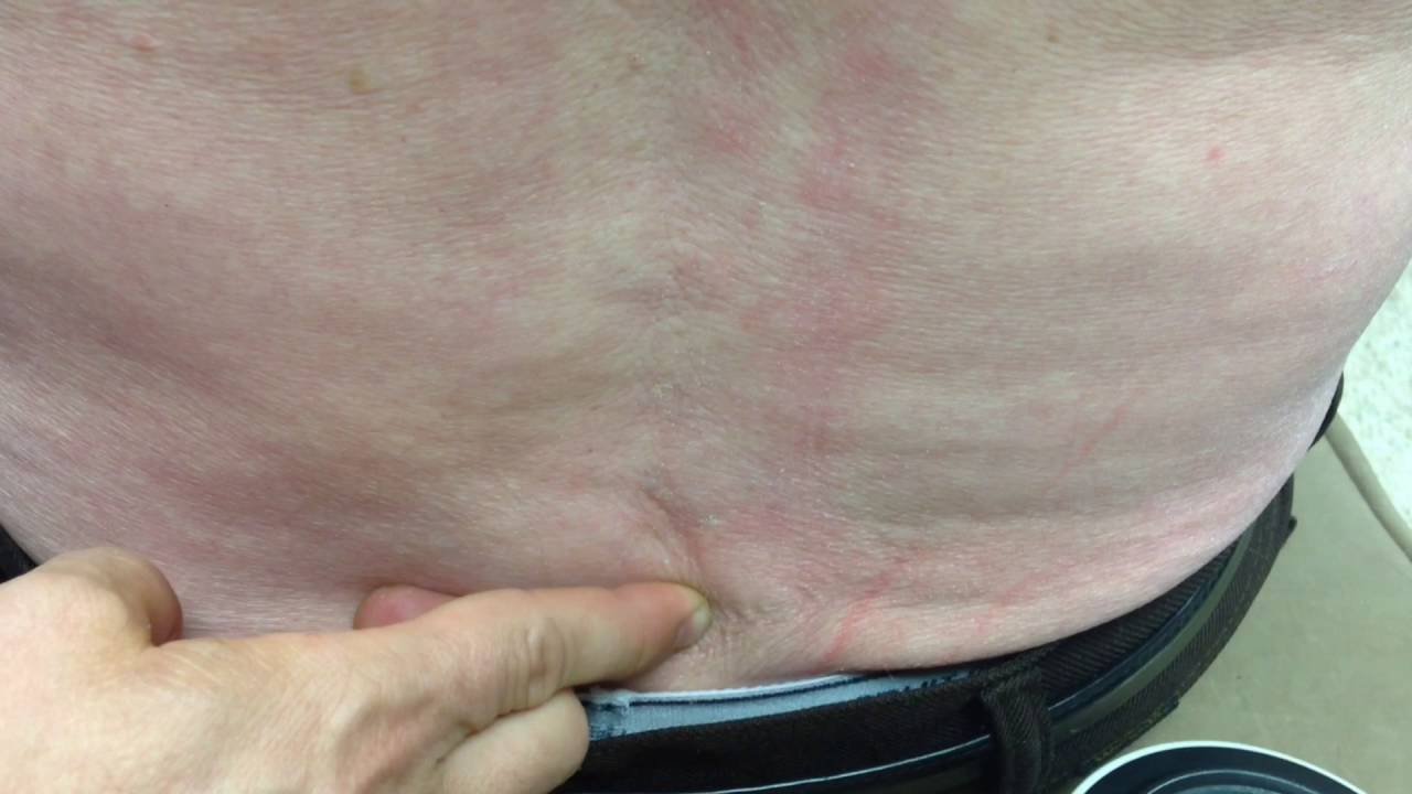 Exam Basics - Pitting Edema - YouTube