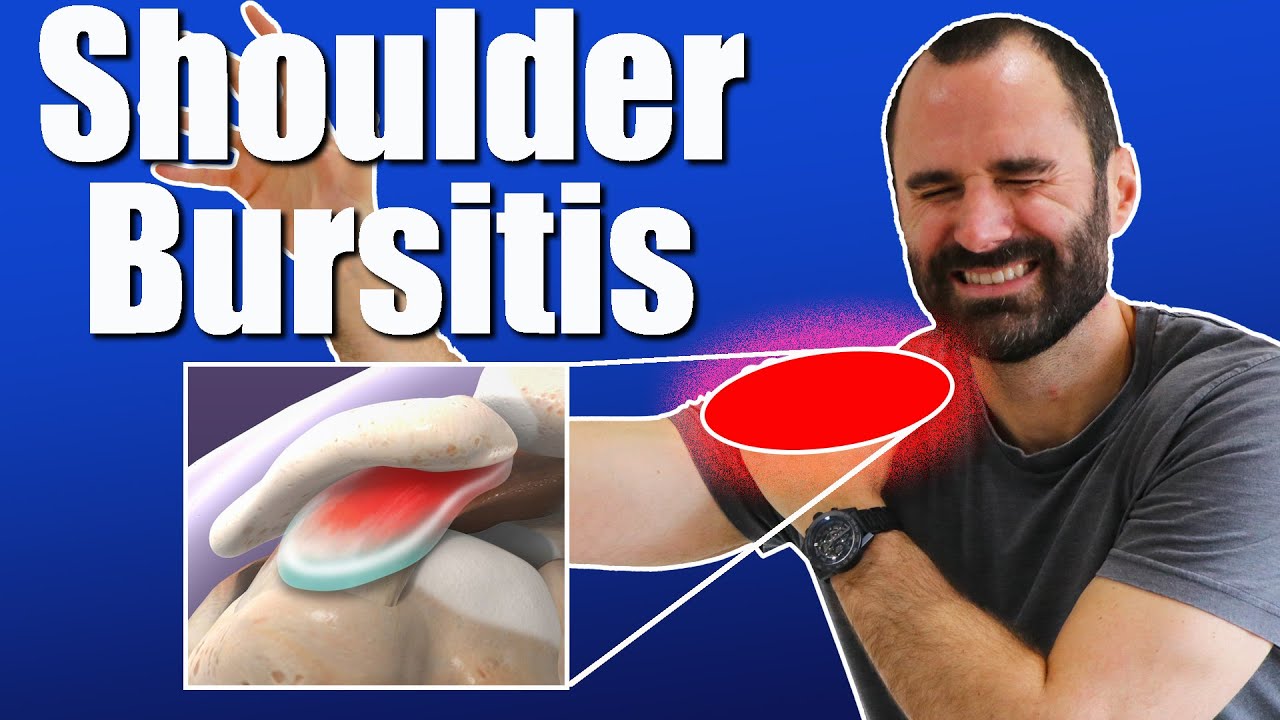 Shoulder Bursitis: Symptoms, Causes, and Effective Exercises for ...