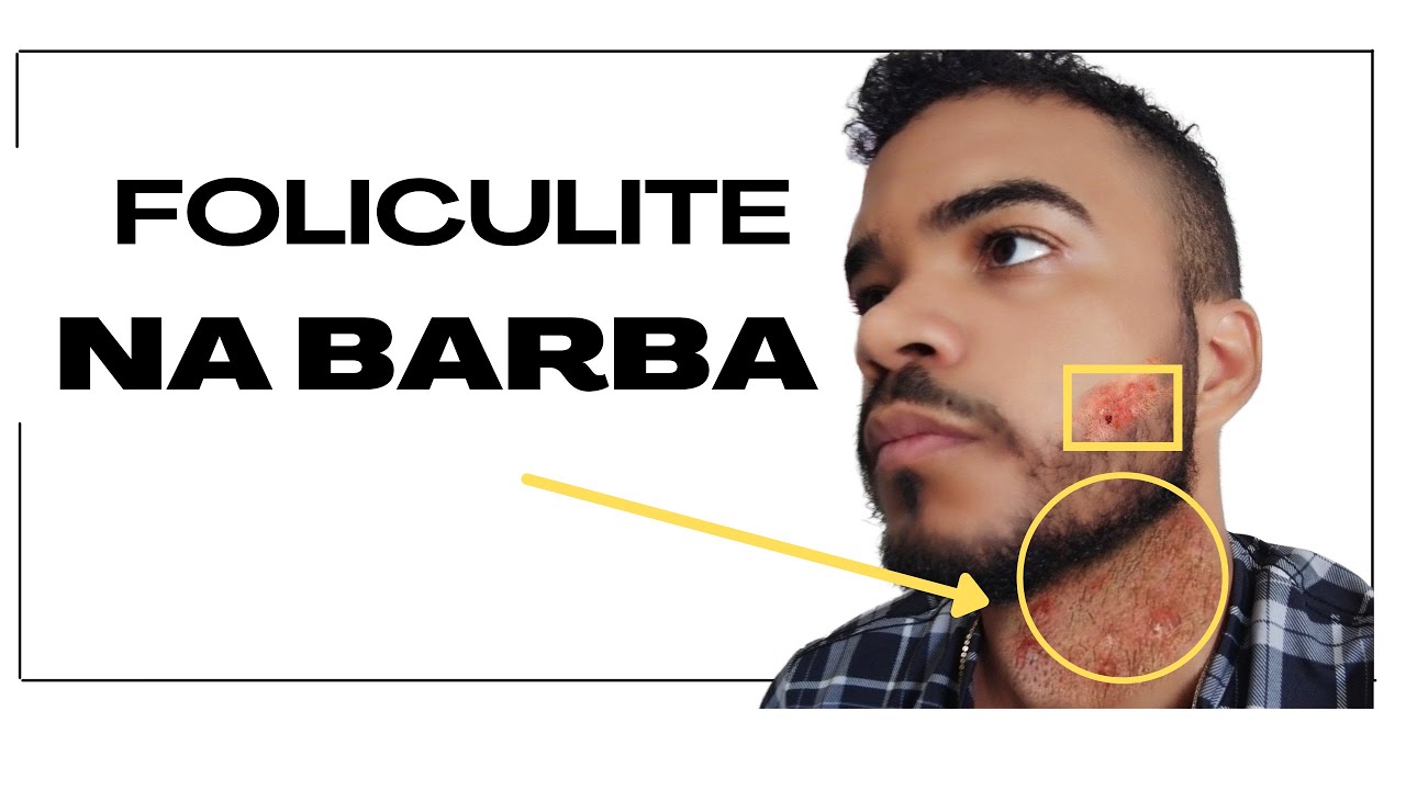 COMO TRATAR A FOLICULITE NA BARBA - YouTube