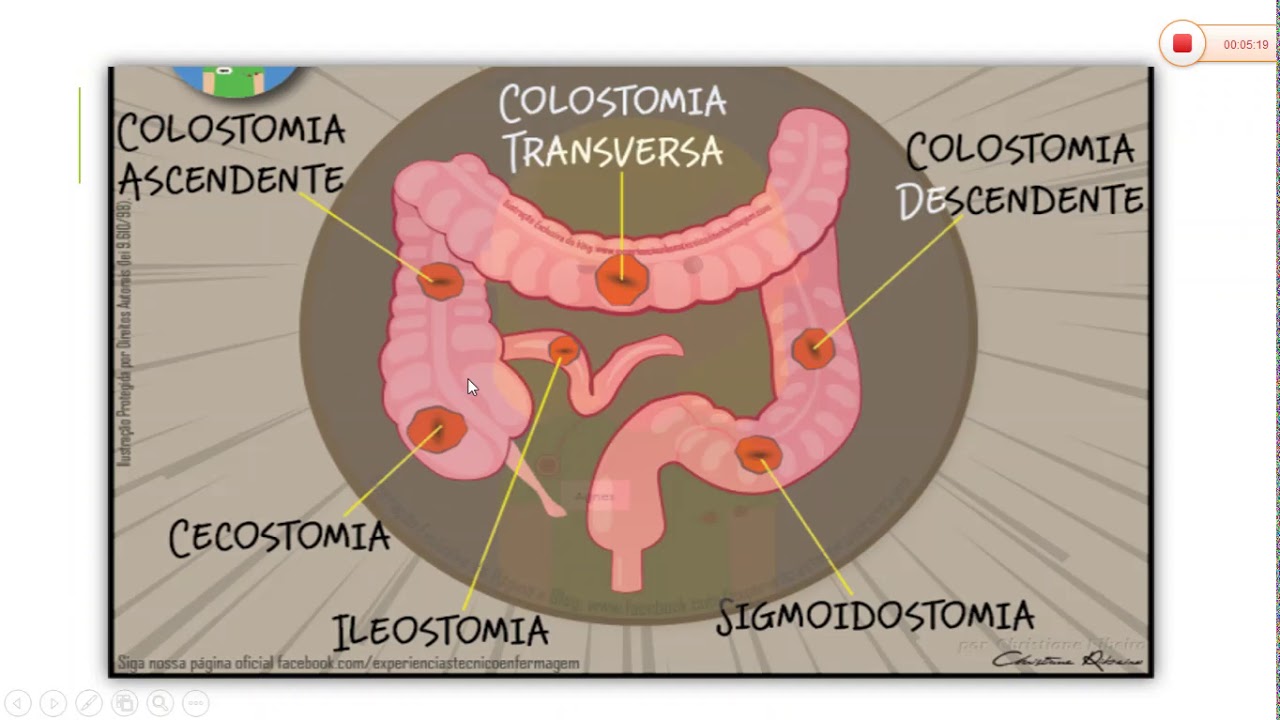 CLÍNICA MÉDICA- ESTOMAS PARTE II. - YouTube