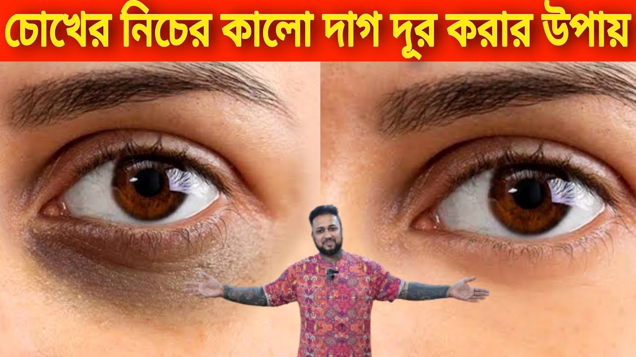চোখের নিচের কালো দাগ দূর করার উপায় | Choker Nicher Kalo Dag Dur Kora ...