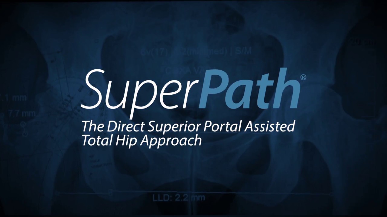 SuperPath Hip Replacement Length of Hospital Stay - YouTube