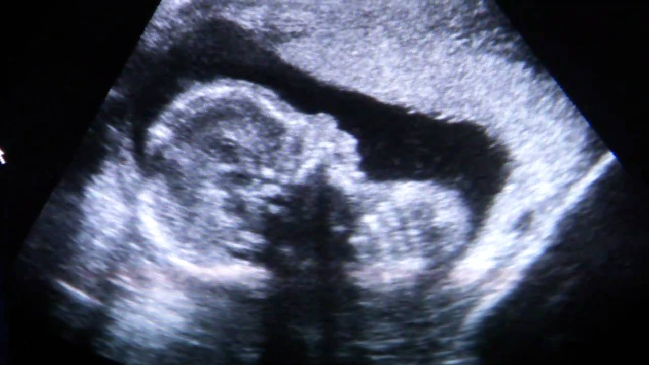 Monroe Baby Ultrasound - YouTube