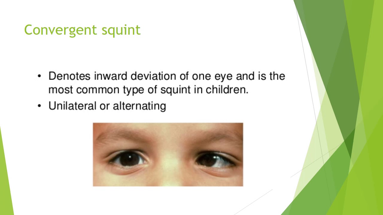 COMITANT SQUINT - YouTube