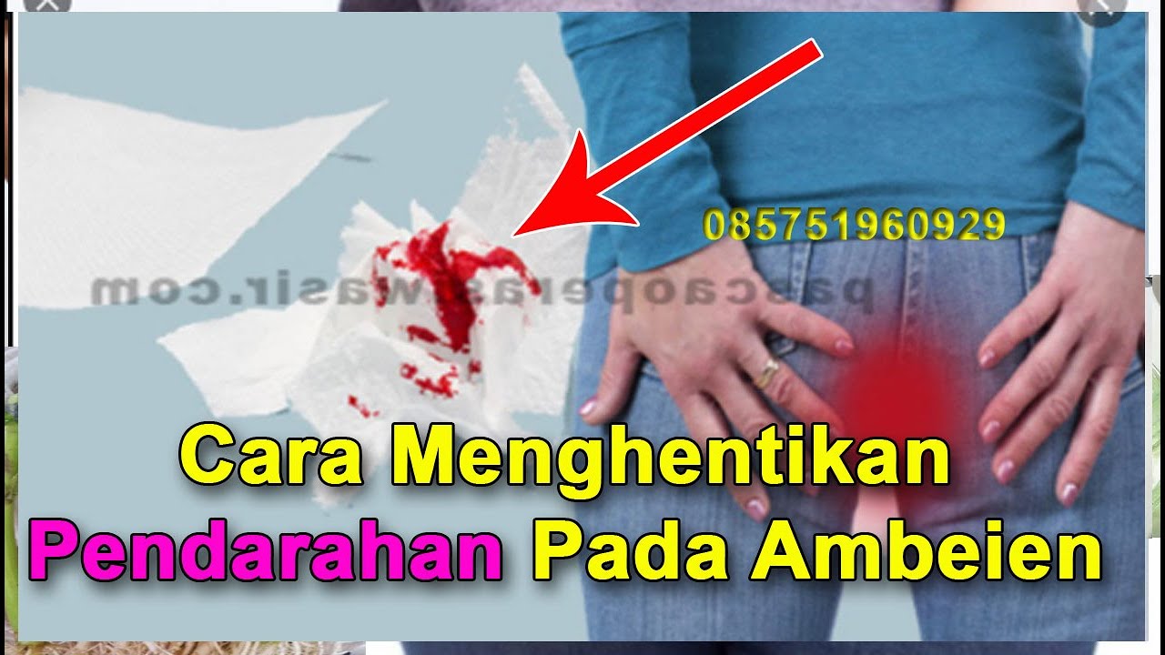 Cara Menghentikan Pendarahan Pada Ambeien - YouTube