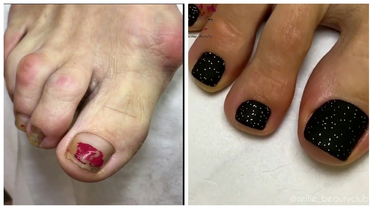 Most Satisfying Pedicure Transformation 😱 best nail polish for toes ...