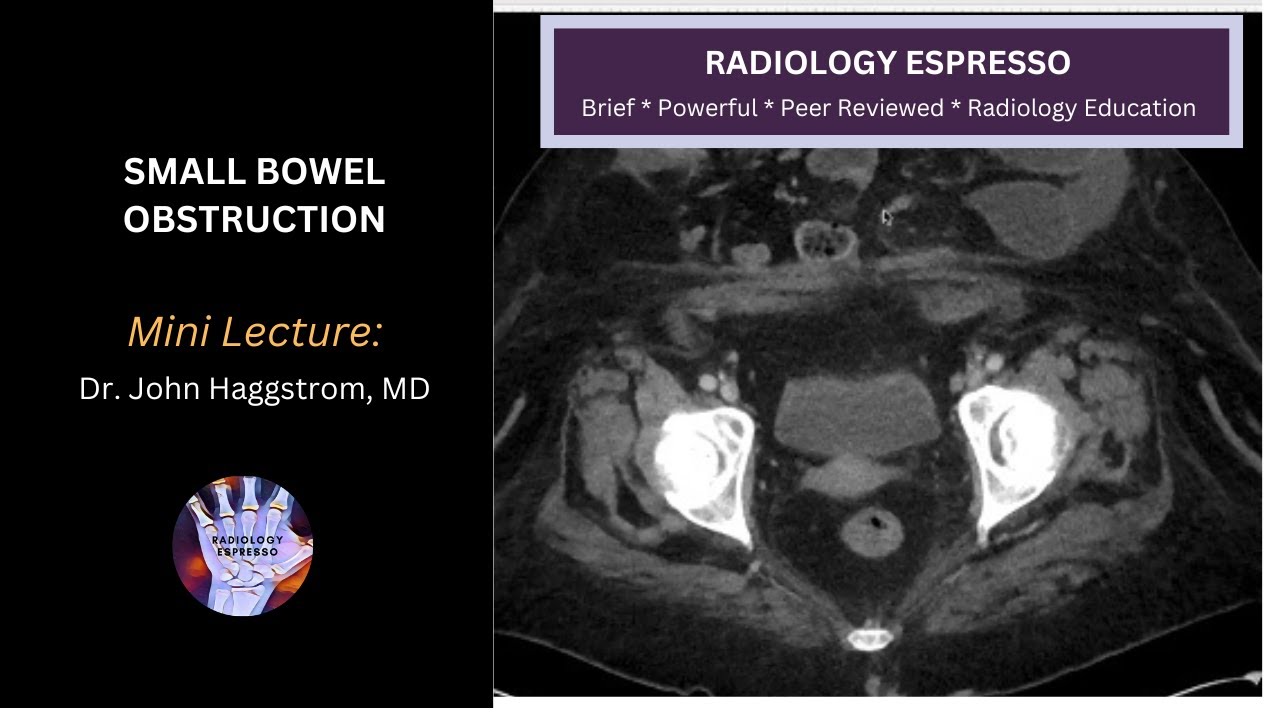 SMALL BOWEL OBSTRUCTION: Mini Lecture, Dr. John Haggstrom, MD - YouTube