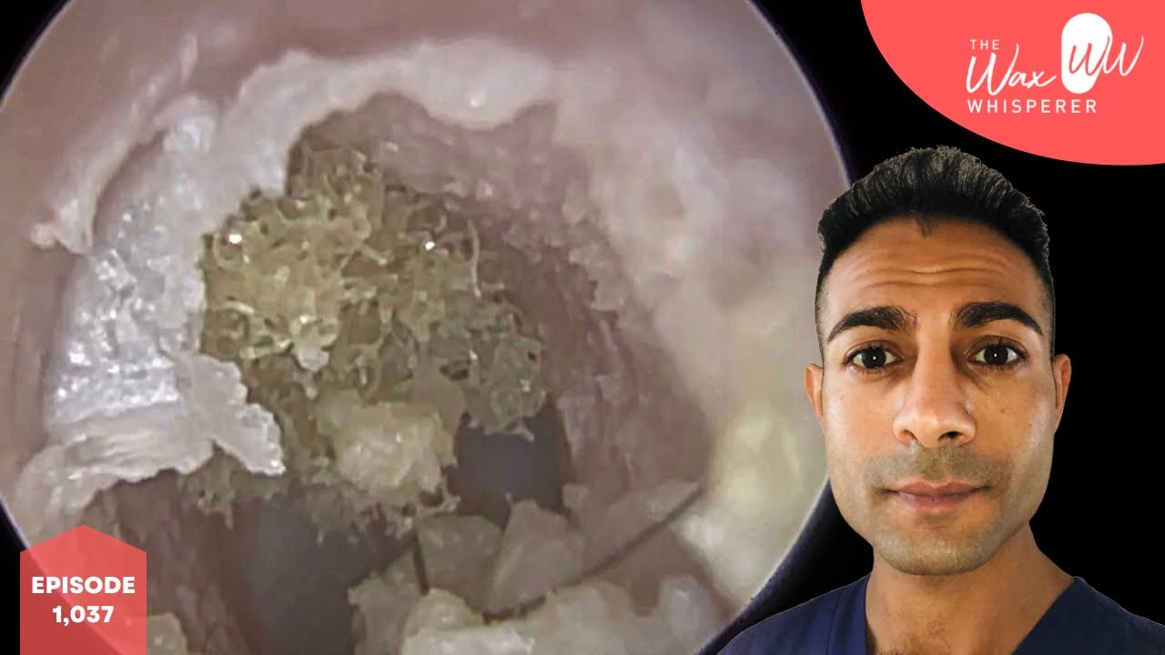 1037 Aspergillus Niger Fungal Ear Infection Otomycosis Youtube