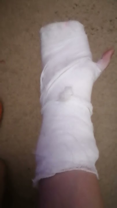 у меня сильный ушиб на пальце😢 Youtube