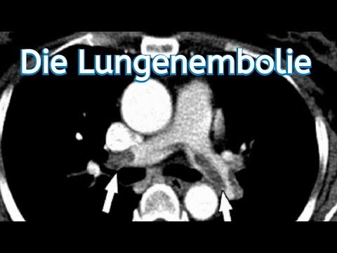 Die Lungenembolie - YouTube