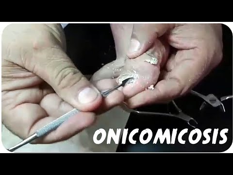 ENTERADA la uña con. ONICOMICOSIS... - YouTube