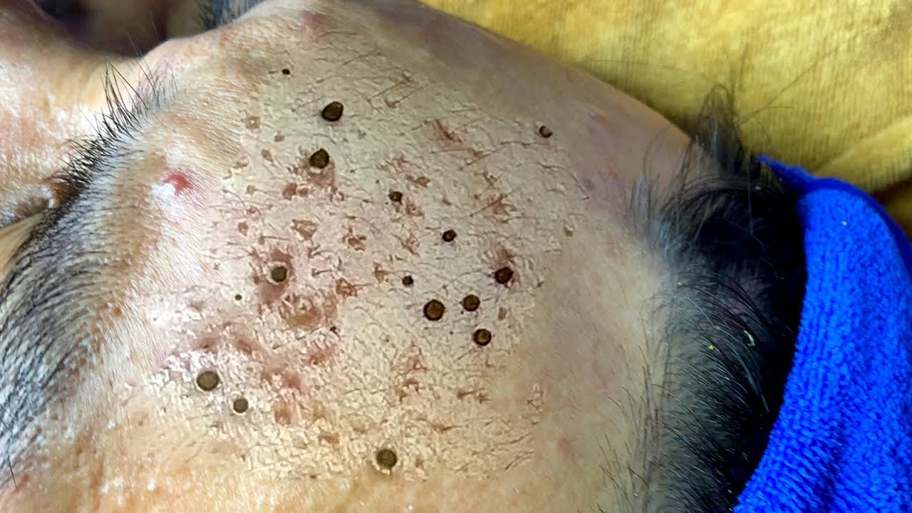 ACNE TREATMENT | Relax daily with pimple #44 - YouTube