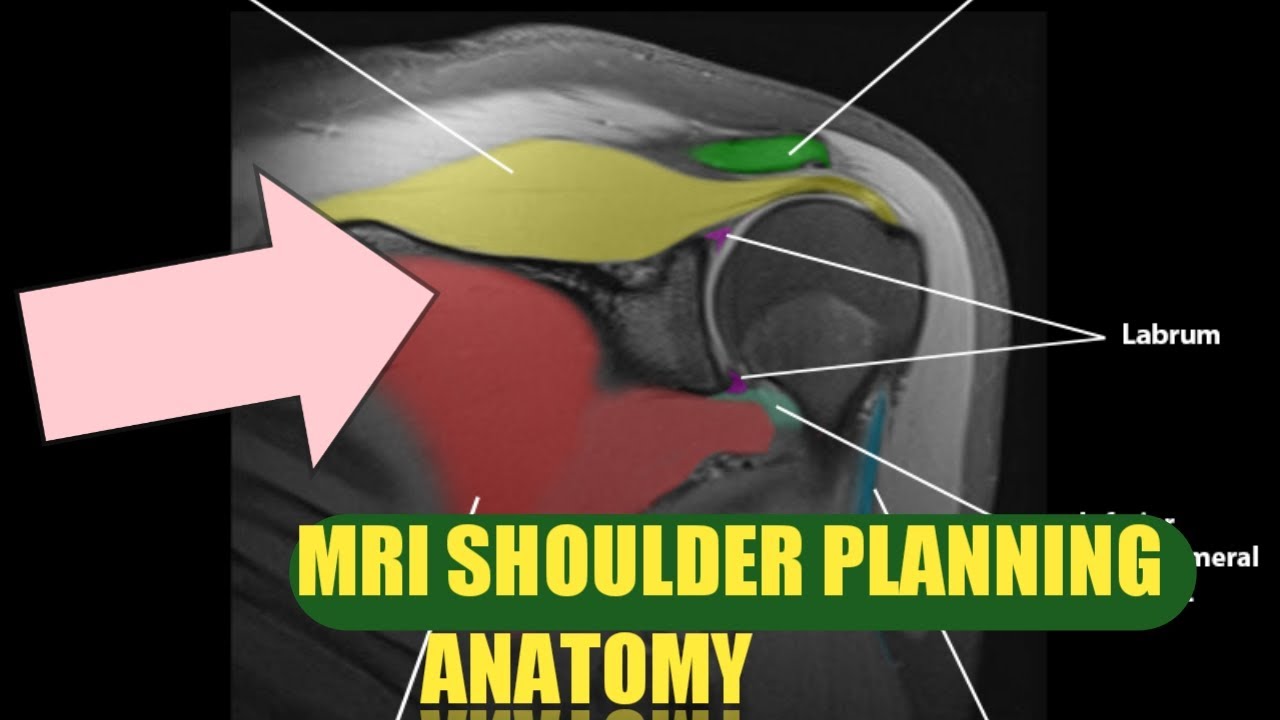 MRI SHOULDER JOINT PLANNING WITH FULL ANATOMY ON 1.5 TESLA MRI PHILIPS ...