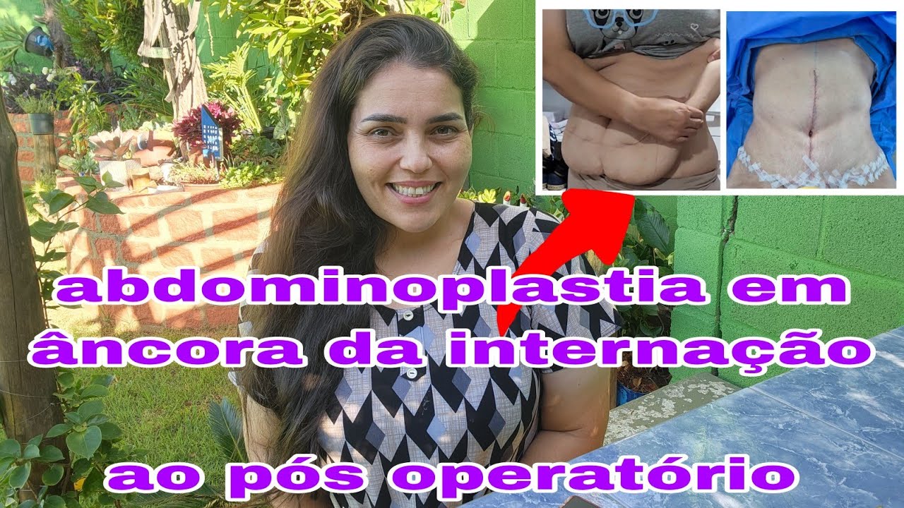 Relato da minha cirurgia abdominoplastia em âncora/completamos 30 dias ...