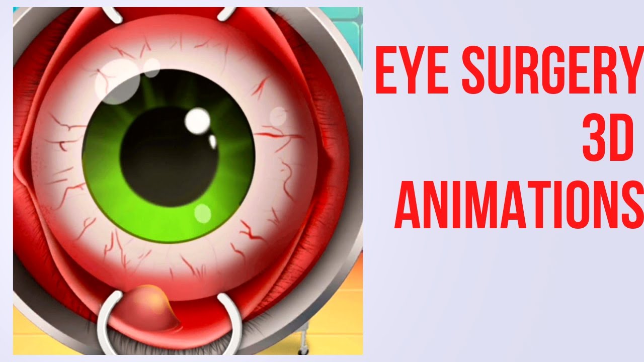 Asmar Eye surgery 3D animations - YouTube