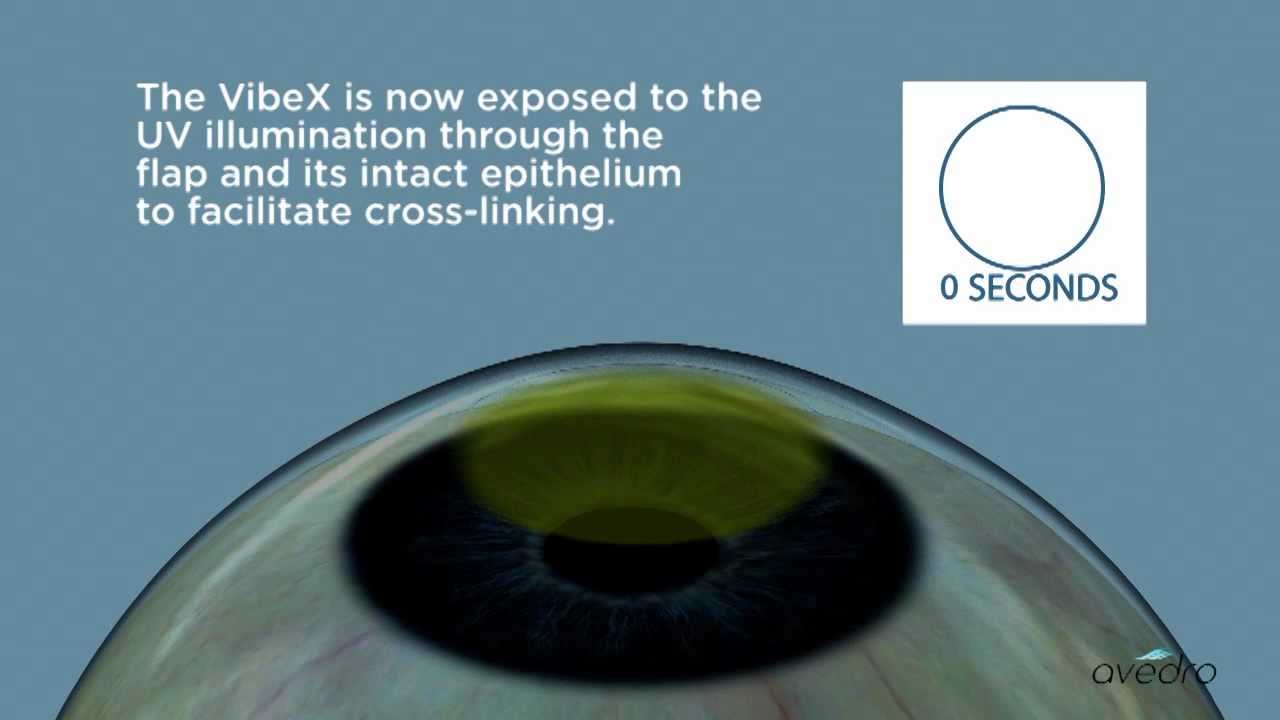 Avedro KXL System - MDEA 2013 Bronze Winner - YouTube