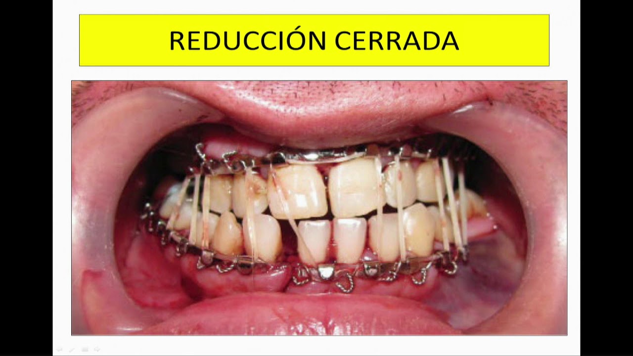 SALUD DENTAL TEMA - FRACTURAS DE CÓNDILO MANDIBULAR - YouTube