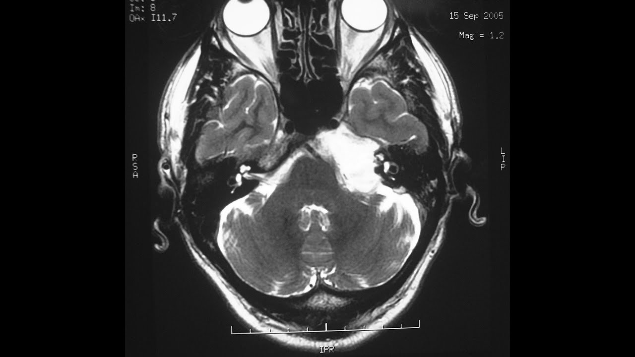 Subtotal petrosectomy in a huge left petrous apex cholesteatoma - YouTube