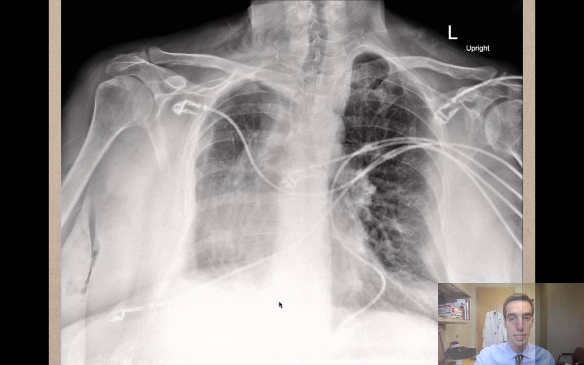 How to Read a Chest X-ray - YouTube