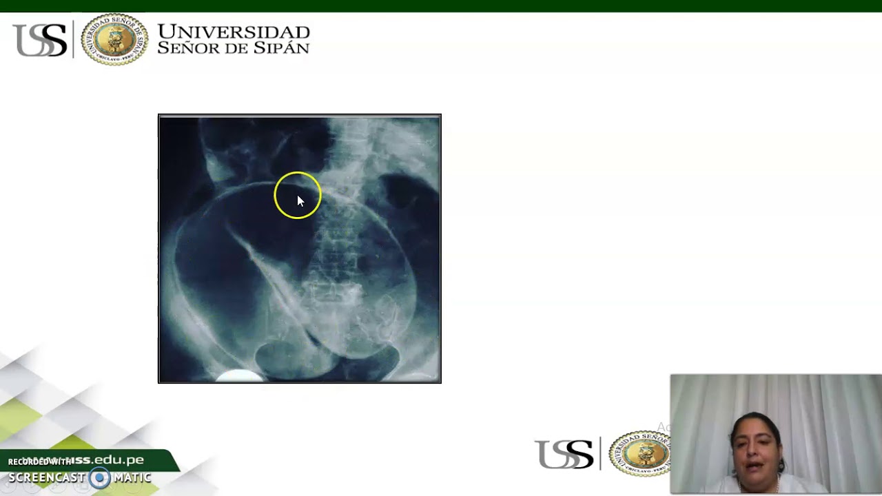 Caso Clínico de vólvulo sigmoides complicado - YouTube