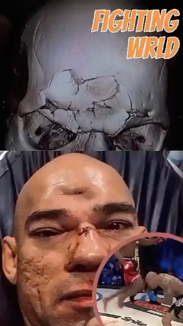 💀MVP On Breaking the Skull Of His Opponent😳💥 #ufc #mma - YouTube