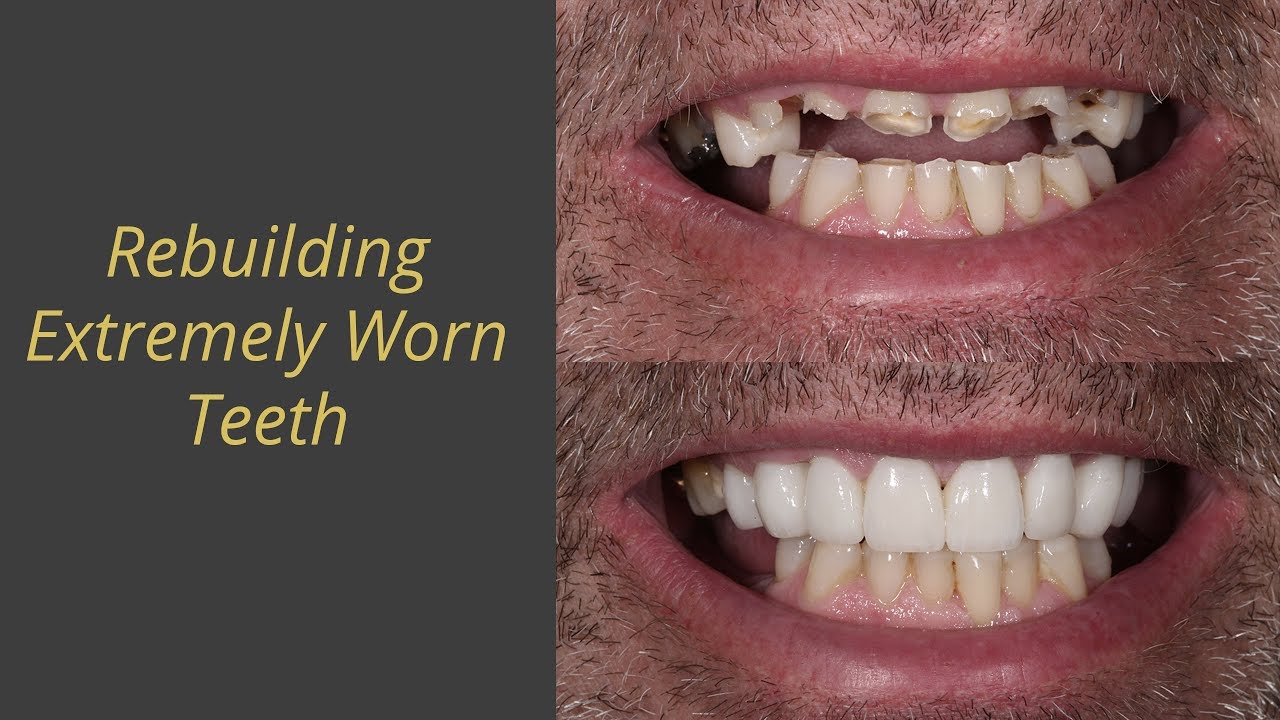 Extreme Tooth Wear - How we rebuilt it - YouTube
