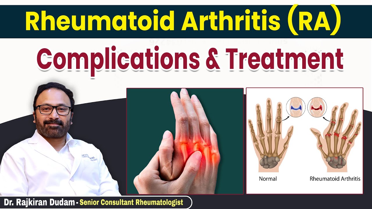 How to cure Rheumatoid Arthritis | Rheumatoid Arthritis Causes Symptoms ...