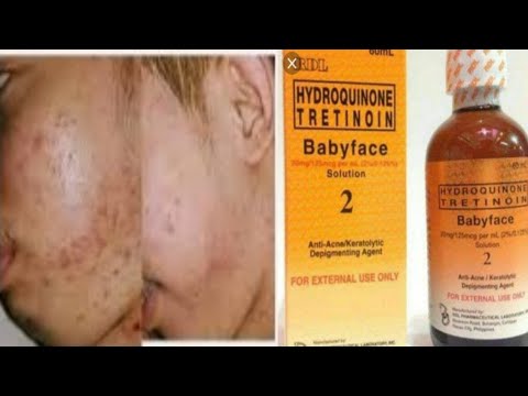 RDL babyface solution 2 / Anti Acne skin peel of review / remedies and ...