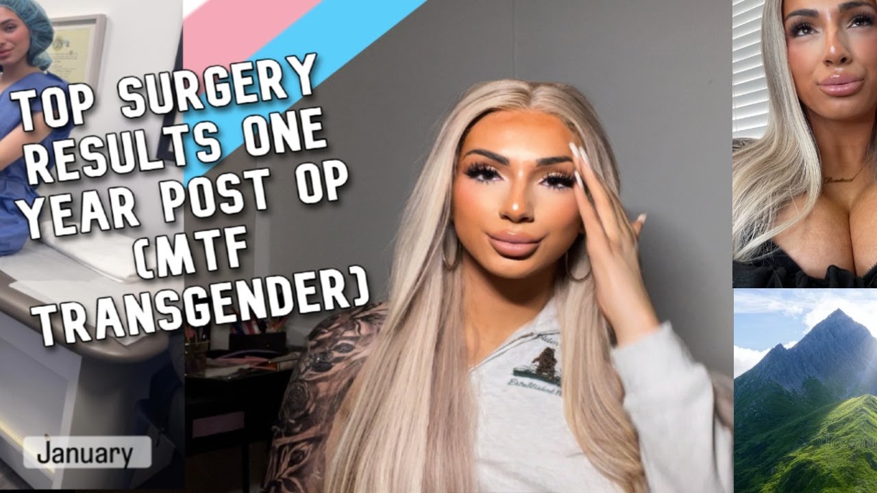 TOP SURGERY RESULTS ONE YEAR POST OP (MTF TRANSGENDER) - YouTube