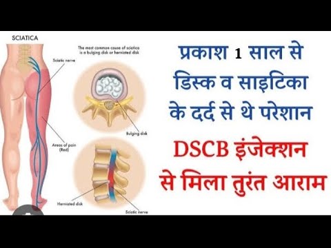 #slip disc ,#lumber canal stenosis ,foot numbness treatment with dscb ...