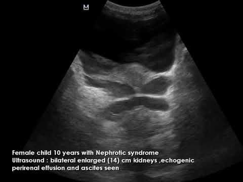 CASE 851 nephrotic syndrome ultrasound - YouTube