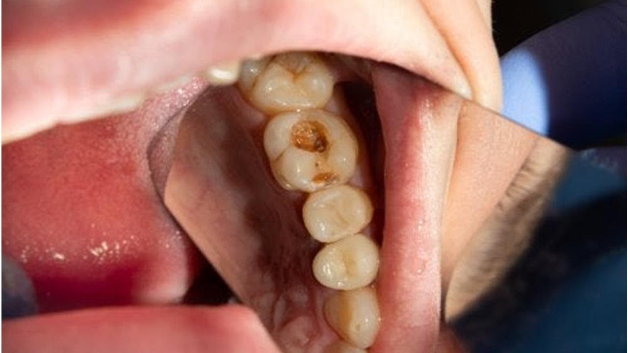 ¿Qué es y cómo se forma la caries? | Maha TV - YouTube