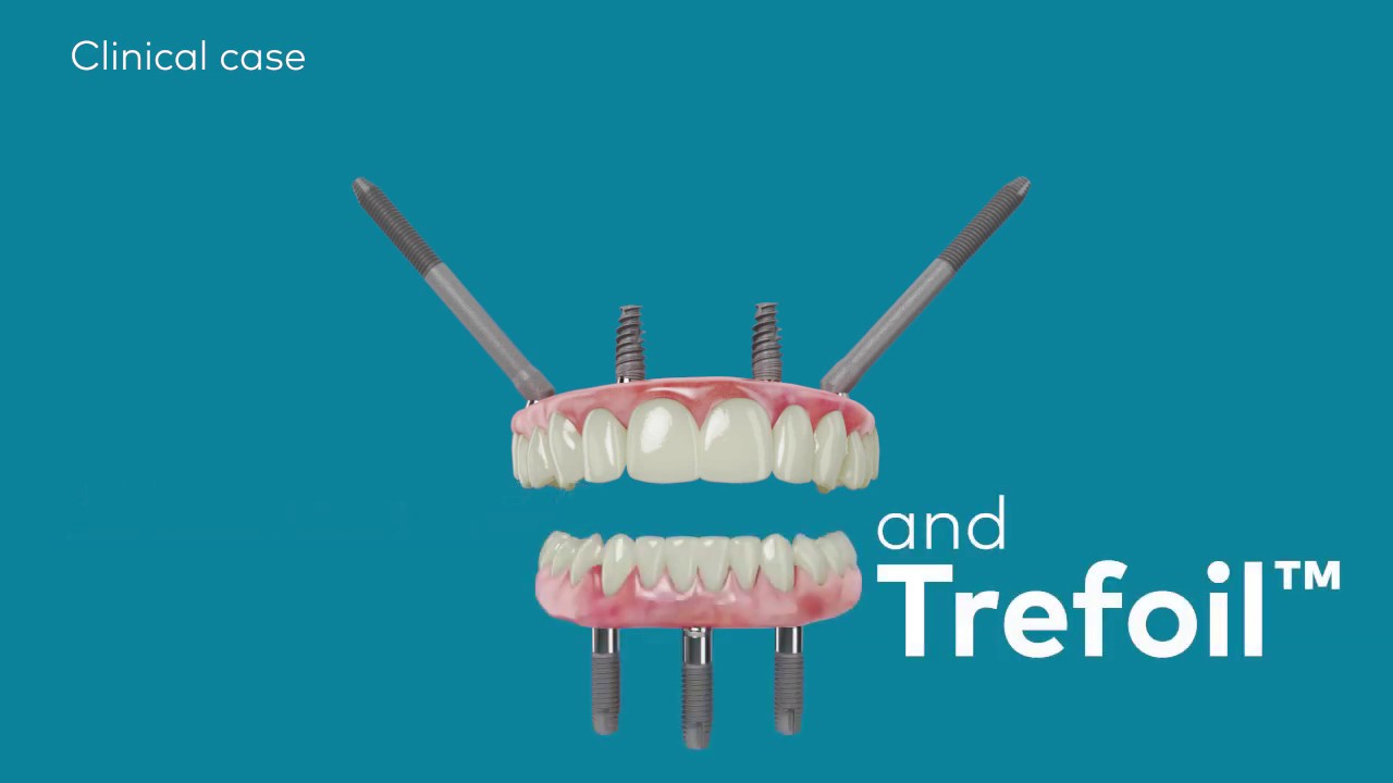 Clinical case: An immediate fixed restoration - YouTube