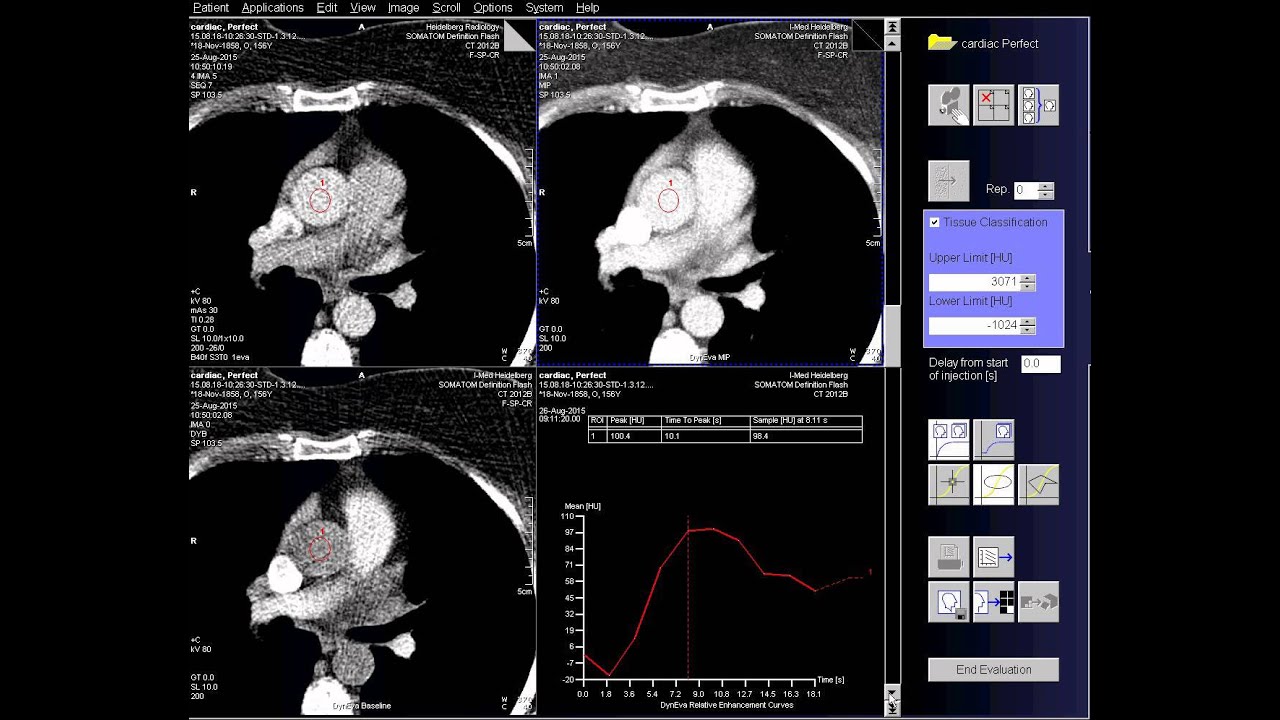 Timing Bolus Definition Flash - YouTube