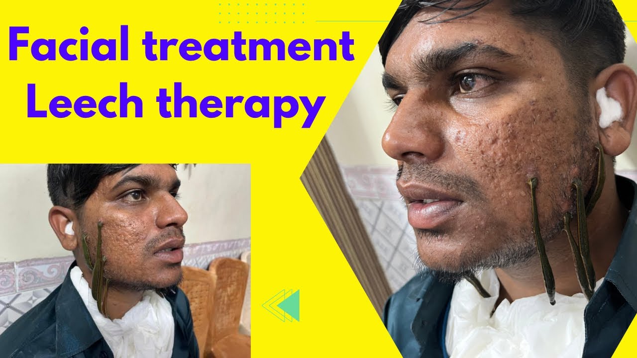 Does leech therapy work for pimples? - मुंहासे को ठीक करेगा जोंक • # ...