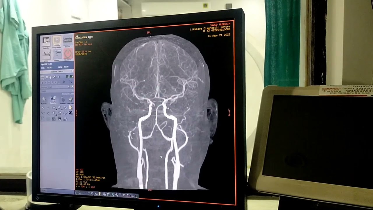 FILMING OF CT SCAN BRAIN ANGIOGRAPHY ON GE 16 SLICE BRIVO - YouTube