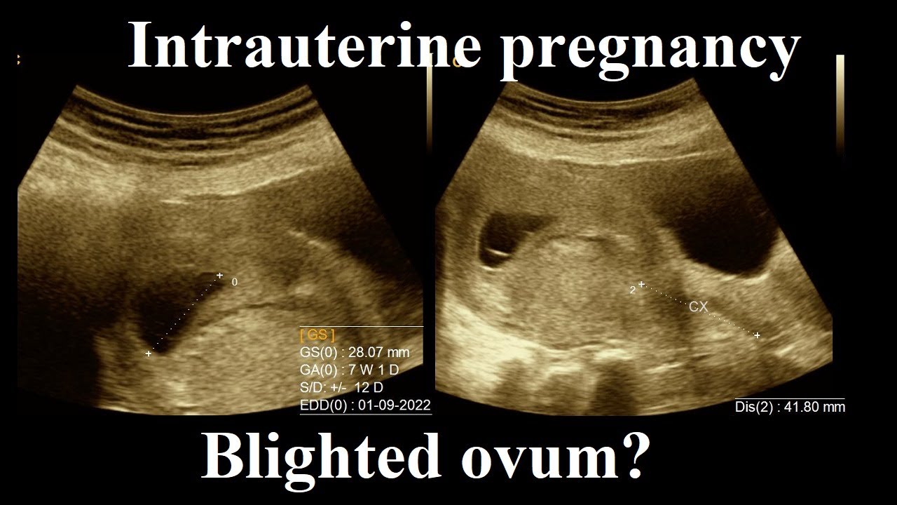 Intrauterine pregnancy | Blighted ovum ultrasound | Amader hospital ...