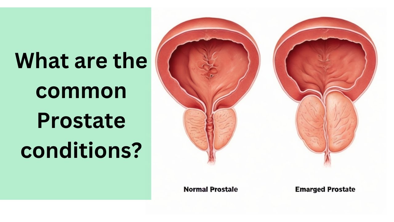 What are the common prostate conditions? - YouTube