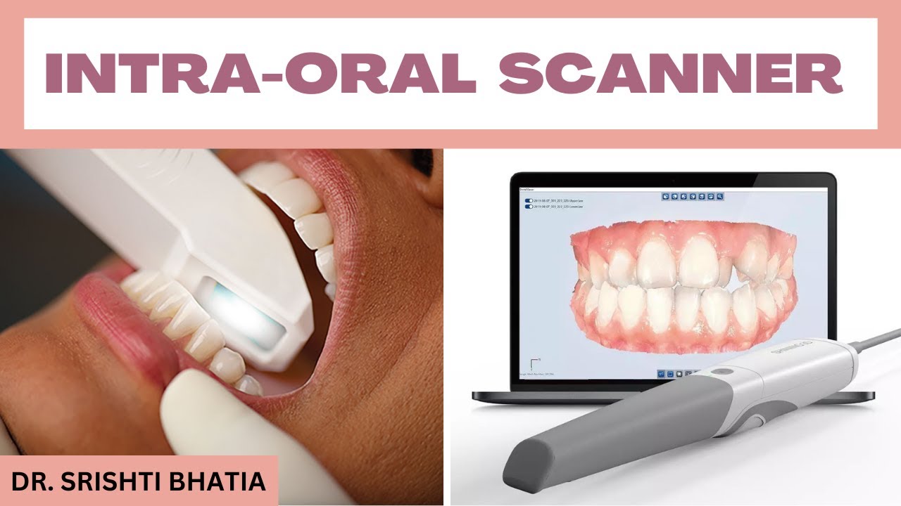 INTRA ORAL SCANNER for No Fuss impression- New addition at BDP; Dr ...