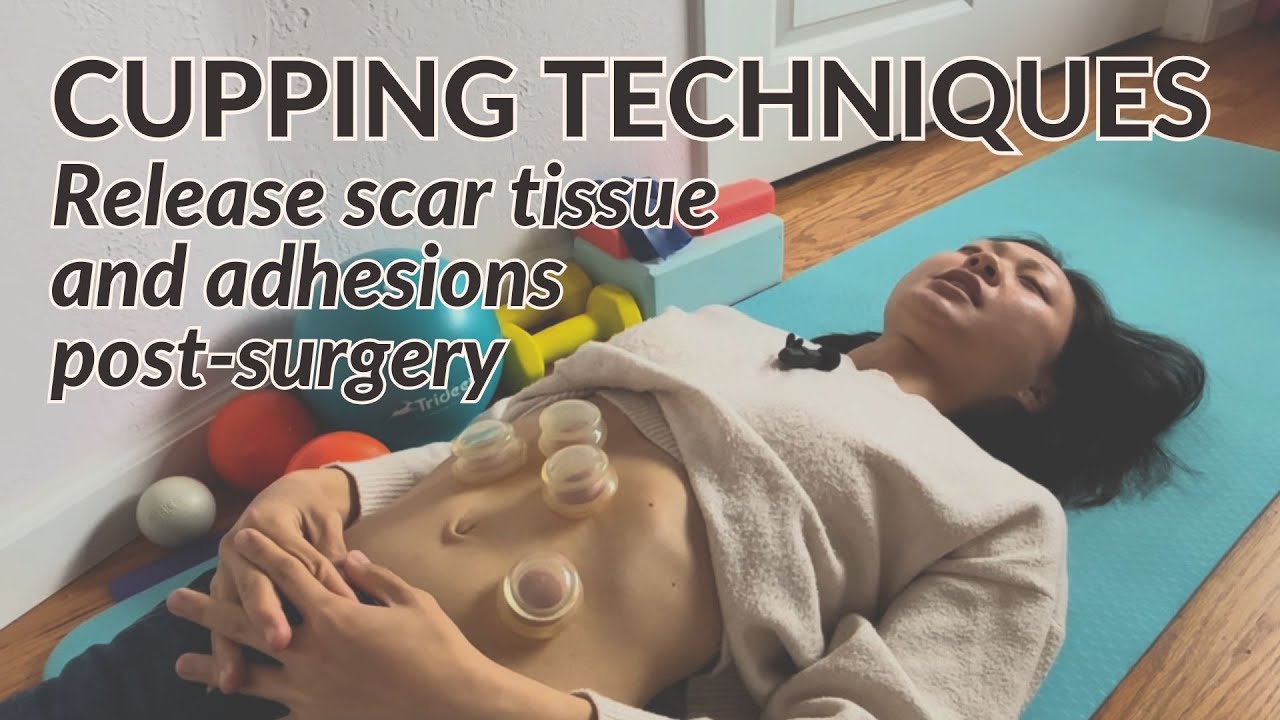 Cupping for Scar Tissue, C-Section, Adhesions, Myofascial Release - YouTube