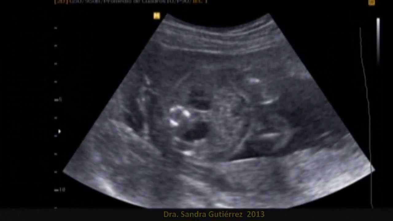 Hidronefrosis bilateral - YouTube