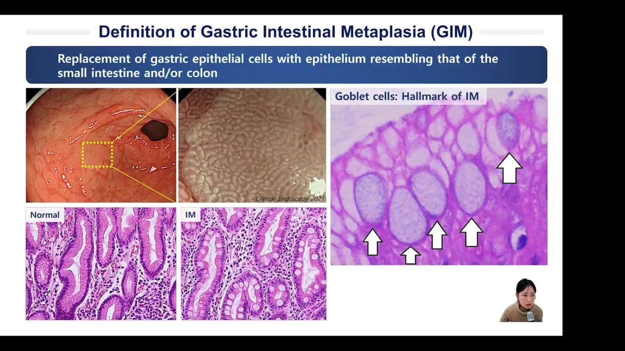Methylation profiles of incomplete intestinal metaplasia in the stomach ...