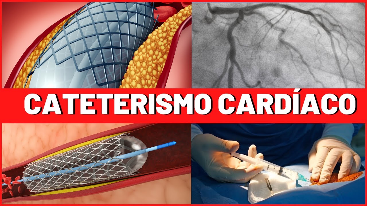 CATETERISMO CARDIACO e ANGIOPLASTIA | COMO É FEITO | RISCOS ...