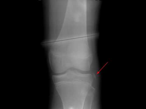 Segond Fracture - YouTube